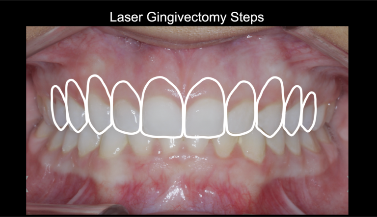 Gingivectomy - Nichols Orthodontics + Aesthetics